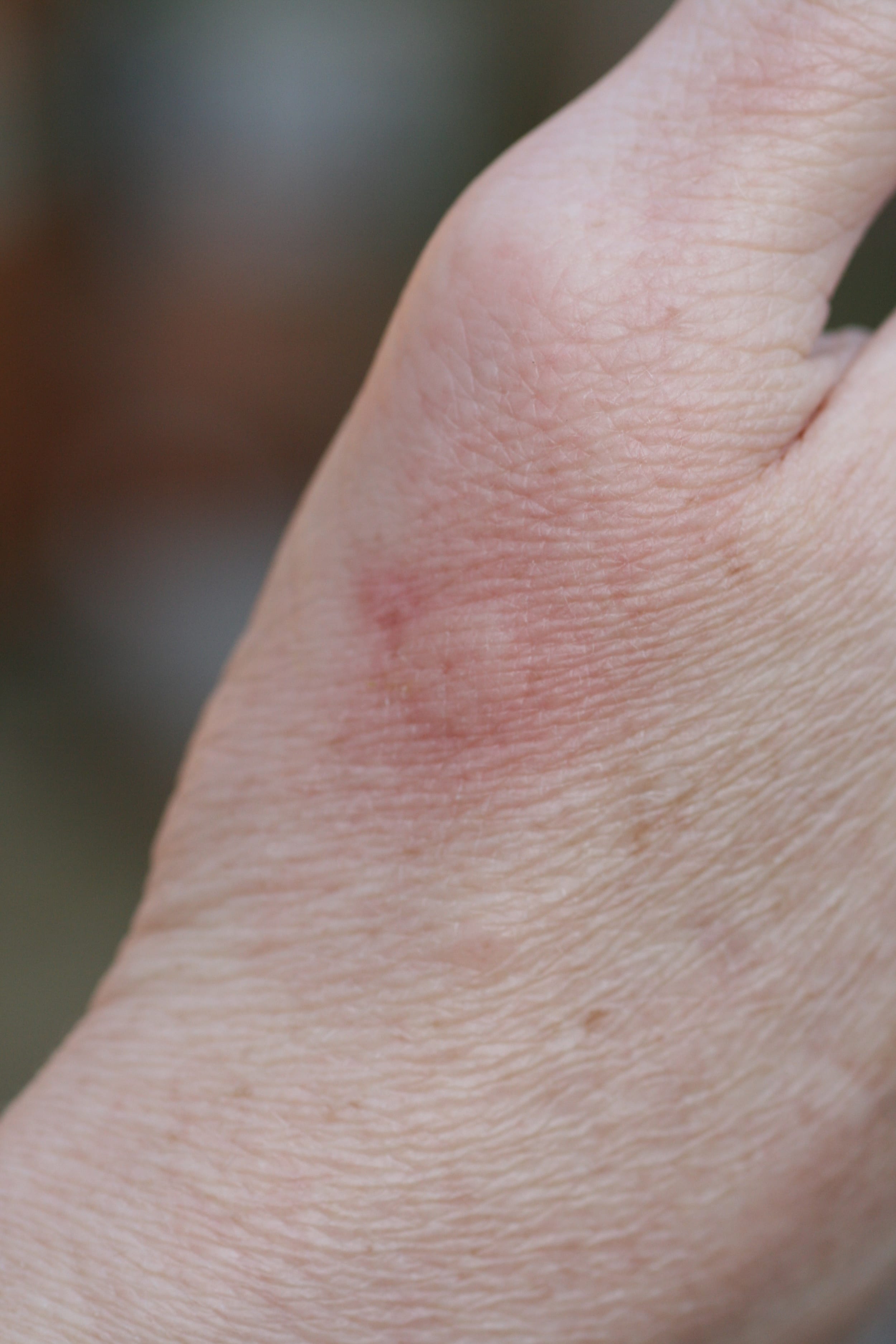 11 WAYS TO PREVENT AND TREAT STINGS Rapid Pest Solutions 11 WAYS TO PREVENT AND TREAT STINGS Rapid Pest Solutions